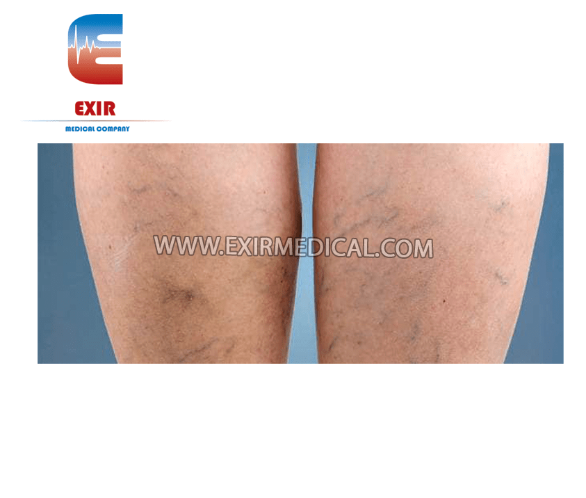 ما هي دوالى الساقين Varicose Veins؟ | Exir Medical Store